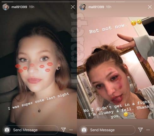 TEEN MOM Rachel Beaver has 4 surgeries, sister Malorie ‘quarantining ...