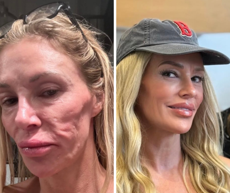 Brandi Glanville Shows Progress She’s Made From Facial Disfigurement ...